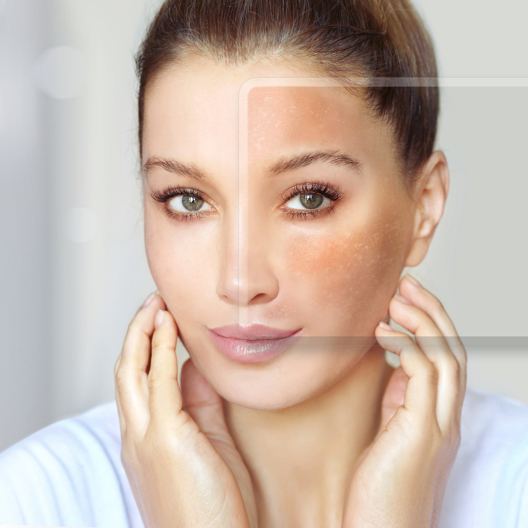 Micro-Needling for Sun Damage Reversal - Vallee Health Repair, PLLC